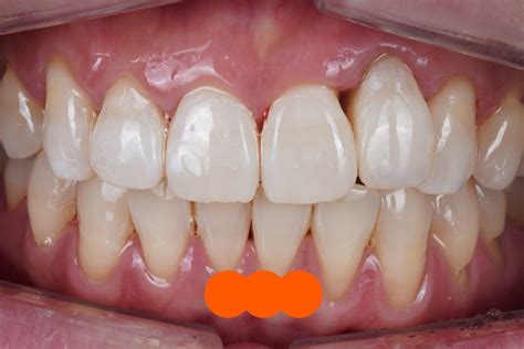 재주좋은 치과의사 측절치 레진 비니어 오래전 옆니 하나가 교정치료에 반응하지 않아 그대로 마무리 후 그냥 지내오셨다고 합니다 현재 상태에서 레진으로 치료하는 것은