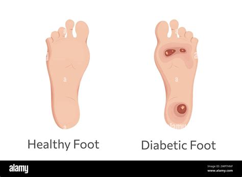 Diabetic And Healthy Feet Vector Illustration Diabetes And Ulcer