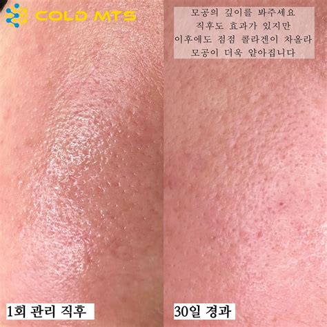 강남플라즈마 Mts 모공관리 1회 관리 하신 직후와 한달 경과 후 사진입니다 직후도 많이 없어