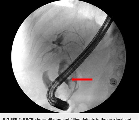 Figure 2 From Common Pathology With Atypical Presentation Acute Cholangitis Semantic Scholar