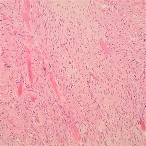 Site Of Partial Glossectomy Anterolateral Right Download Scientific