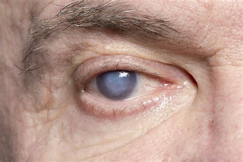 Cataracts Motiyabind Symptoms Treatments And Everything