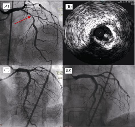 A Case Of Lad Bifurcation Lesion Undergone Single Stenting In