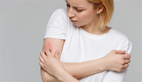 Dermatitis Atópica sin Corticoides Vistafarma