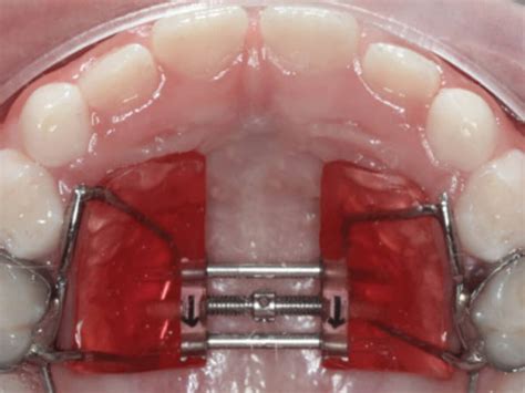 How To Expand Palate Expander