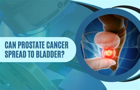 Can Prostate Cancer Spread To Bladder Dr Sridhar Ps