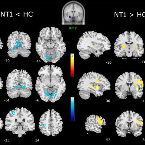 Reduced Left And Increased Right Functional Connectivity Of