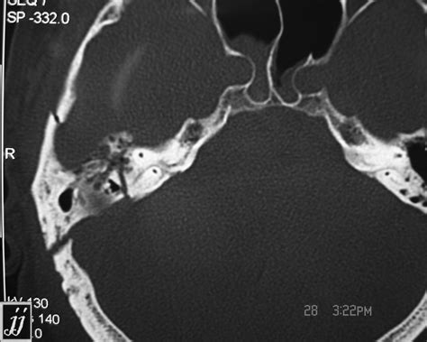 Right Temporal Bone Comminuted Fracture Floating Radiopaedia