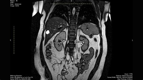 Case 1 57 Year Old Female Presents With History Of Right Renal Mass Mri Online Is Now Medality
