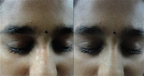 Permanent Makeup For Vitiligo In India Saubhaya Makeup