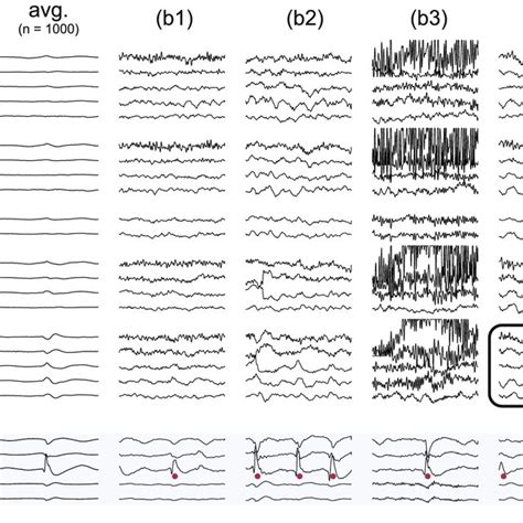 Examples Of Scalp Eeg Waveforms Associated With Intracranial Ieds A Download Scientific