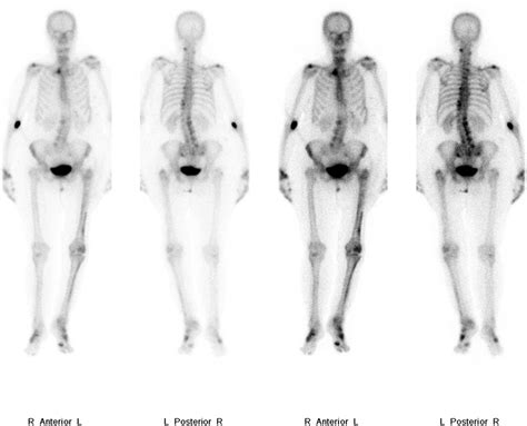 Bone Scan Images