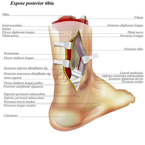 Ankle Posterolateral Approach Approaches Orthobullets