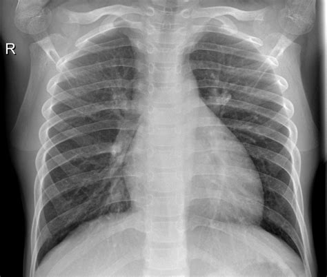 Dheiverchestxraypneumoniapredictor At Main