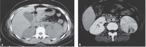 Renal Inflammatory Disease Radiology Key