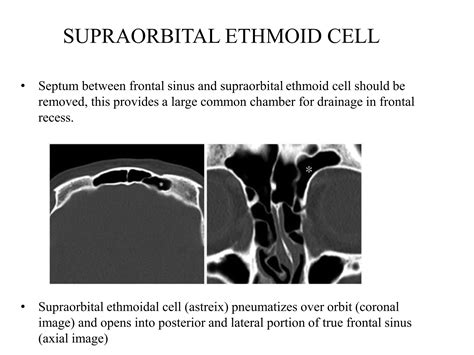 Surgical Approaches To Frontal Sinus Ppt Pptx