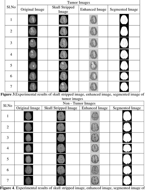 Figure 1 From Identifying Brain Tumour From Mri Image Using Modified Fcm And Support Vector