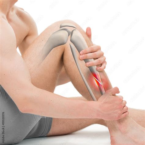 Oblique Fracture Of The Tibia Leg Fracture 3d Illustration Stock