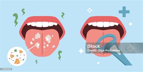 악취 제거 혀 청소 구취 예방 구강 위생 플라그 제거 과정 구취 퇴치 박테리아 건강 관리 만화 평면 고립 Nowaday 벡터