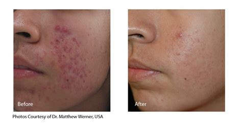 Acne Treatment Inkfree Md Laser Clinic In Houston Tx