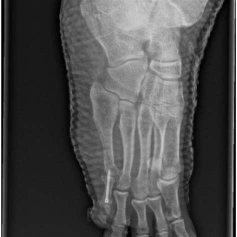 Postoperative Dorsoplantar Nonweightbearing Radiograph Of The Right