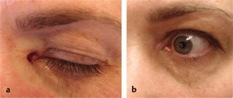 Medial Canthal Eyelid Reconstruction Ento Key
