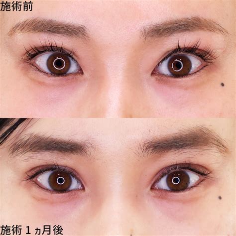 もうやり直しは必要ない。全切開で希望の幅広二重に【二重全切開】｜症例写真・ビフォーアフター｜美容整形･美容外科のtaクリニックグループ