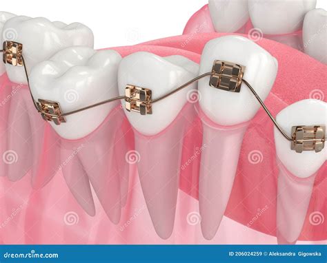 D Render Of Teeth Alignment By Orthodontic Braces Stock Illustration Illustration Of