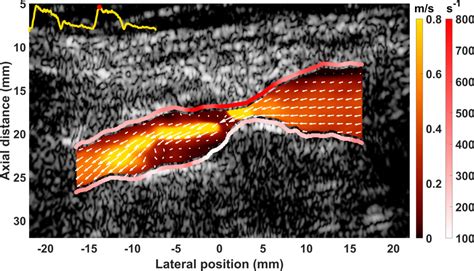 Vector Flow Imaging In Arteries Creatis