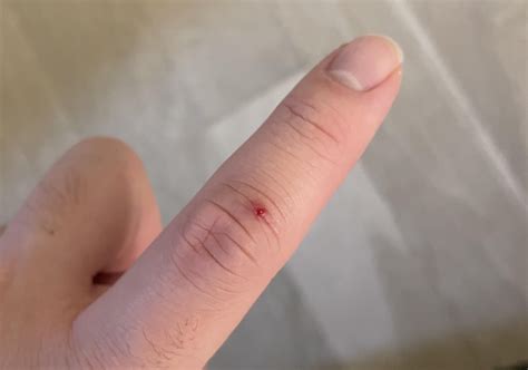 What Is This On My Index Finger Knuckle R Skin