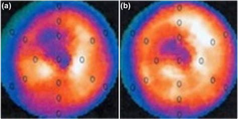 Sestamibi Treadmill Stress Test Performed In December 2010 Download Scientific Diagram