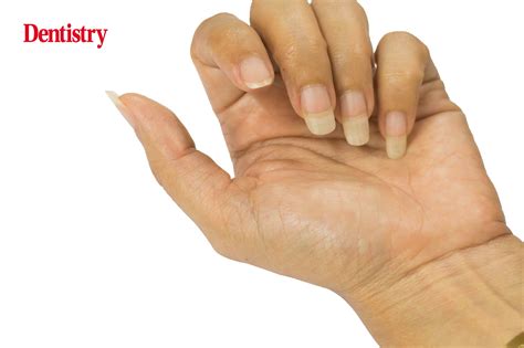 Dental Nurse Loses Discrimination Case After Refusing To Cut Nails