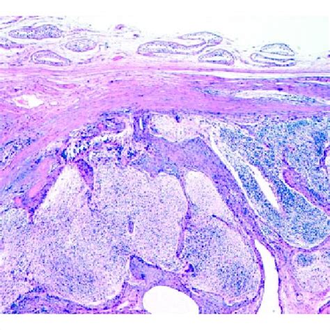 At Low Magnification The Testis Shows Immature Teratoma With