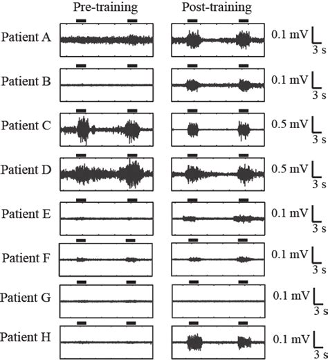 Comparison Of Electromyogram Emg Activities Pre And Download