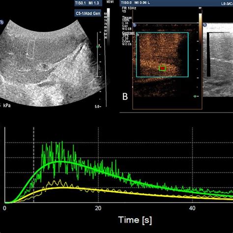 Pdf Assessment Of Liver Fibrosis By Ultrasound Elastography And