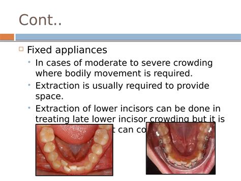 262054548 Late Lower Incisor Crowding Pdf