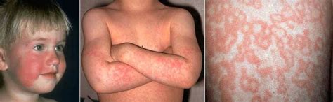 Erythema Infectiosum Causes Medizzy