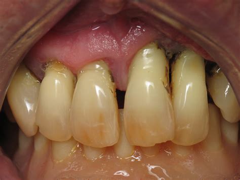 Gingivitis As Related To Gum Disease Pictures