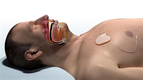 Inspire Upper Airway Stimulation Not Working For Your Sleep Apnea