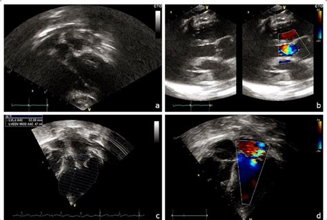 Representative Echocardiographic Images From Two Mps Vi Patients