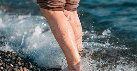 What You Should Know About Great Saphenous Vein Thrombosis