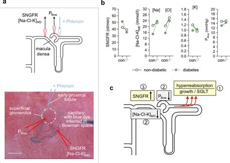 The Tubular Hypothesis Of Diabetic Glomerular Hyperfiltration A B In