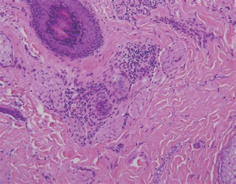 Figure 4 From Treatment Of Atypical Pyoderma Gangrenosum On The Face Semantic Scholar