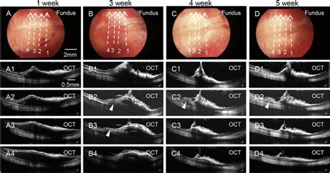 Real Time Oct Guidance And Multimodal Imaging Monitoring Of Subretinal Injection Induced
