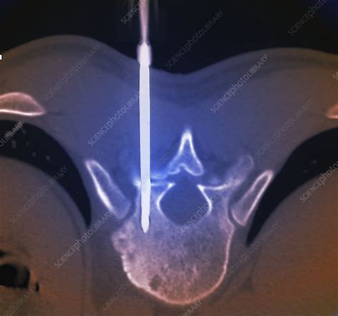 Treatment Of Secondary Bone Cancer In The Spine Ct Scan Stock Image