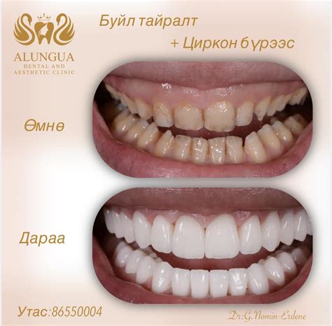 Шүдний бүрээс хийлгэх өртөг яагаад өндөр байдаг вэ гэж үү Шүд гэмтвэл түүнийг хамгаалахын тулд