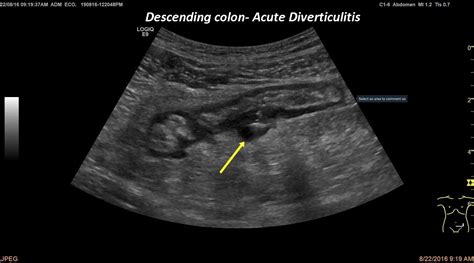 Acute Diverticulitis [1 Image] Efsumb