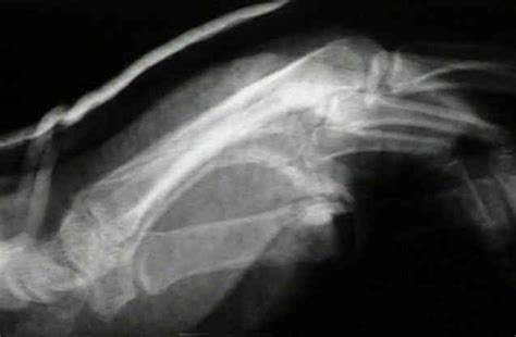 Boxers Fracture Metacarpal Neck Wheeless Textbook Of Orthopaedics