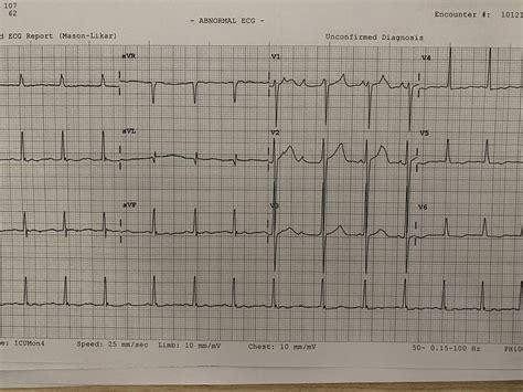 Is The Qtc Accurate In Atrial Fibrillation Rcardiology