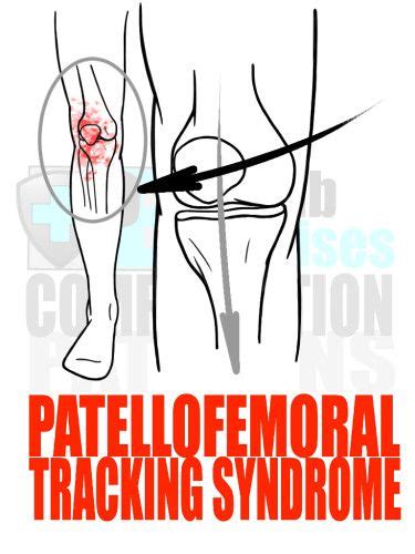 List Of Common Compensation Patterns And Movement Dysfunctions Artofit